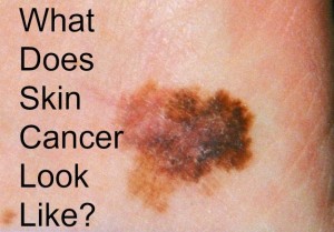 Do You Know What Skin Cancer Looks Like? – Bath and Body